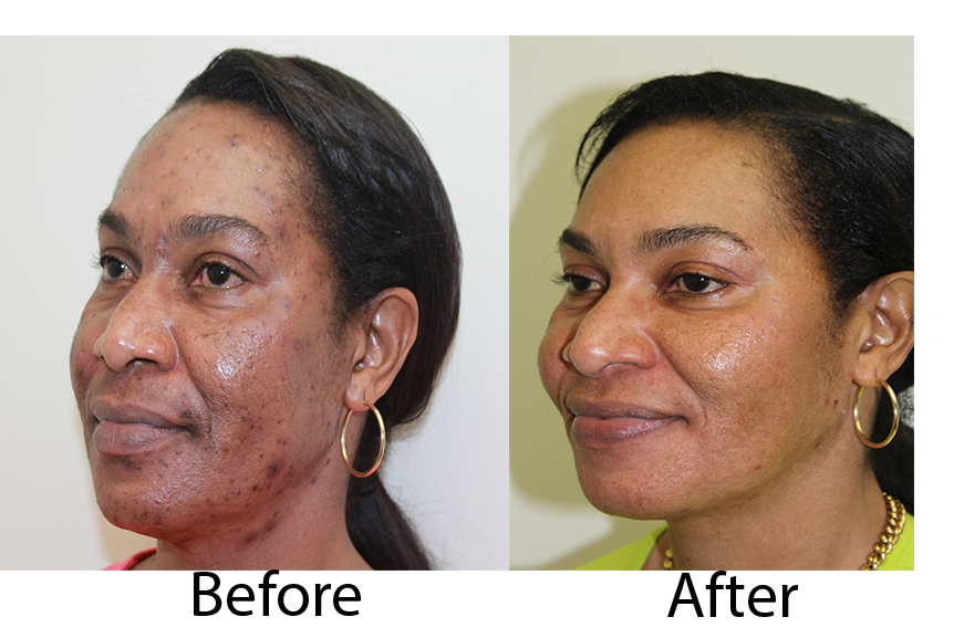 Post Laser Hyperpigmentation Melasma Dark Skin 48 OFF Post Laser Hyperpigmentation Melasma Dark Skin 48 OFF