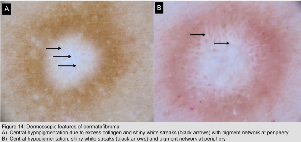 Practical Dermoscopy – Part 1 - Next Steps in Dermatology