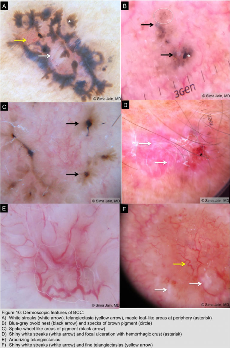 Practical Dermoscopy – Part 1 - Next Steps in Dermatology