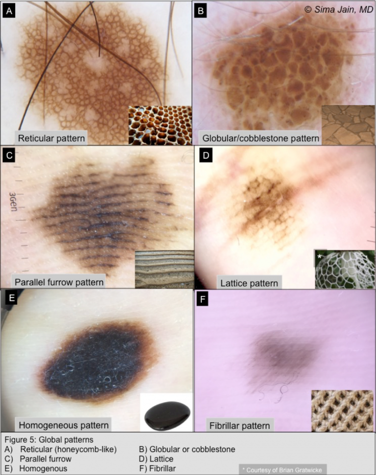 Practical Dermoscopy – Part 1 - Next Steps in Dermatology