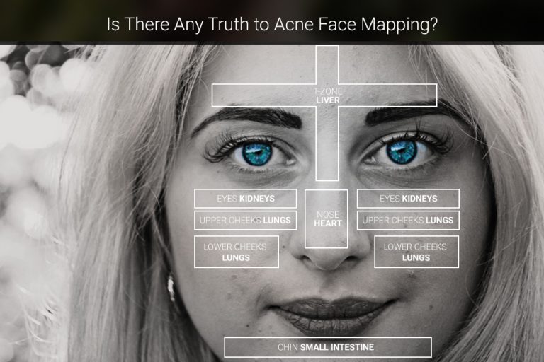 Patient Buzz: Is There Any Truth to Acne Face Mapping? The Expert ... Patient Buzz: Is There Any Truth to Acne Face Mapping? The Expert ...