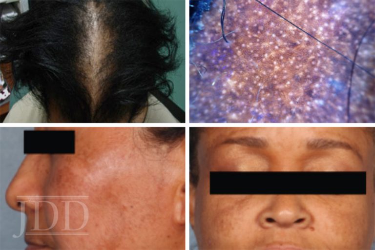 Medical Updates in Skin of Color - Next Steps in Dermatology