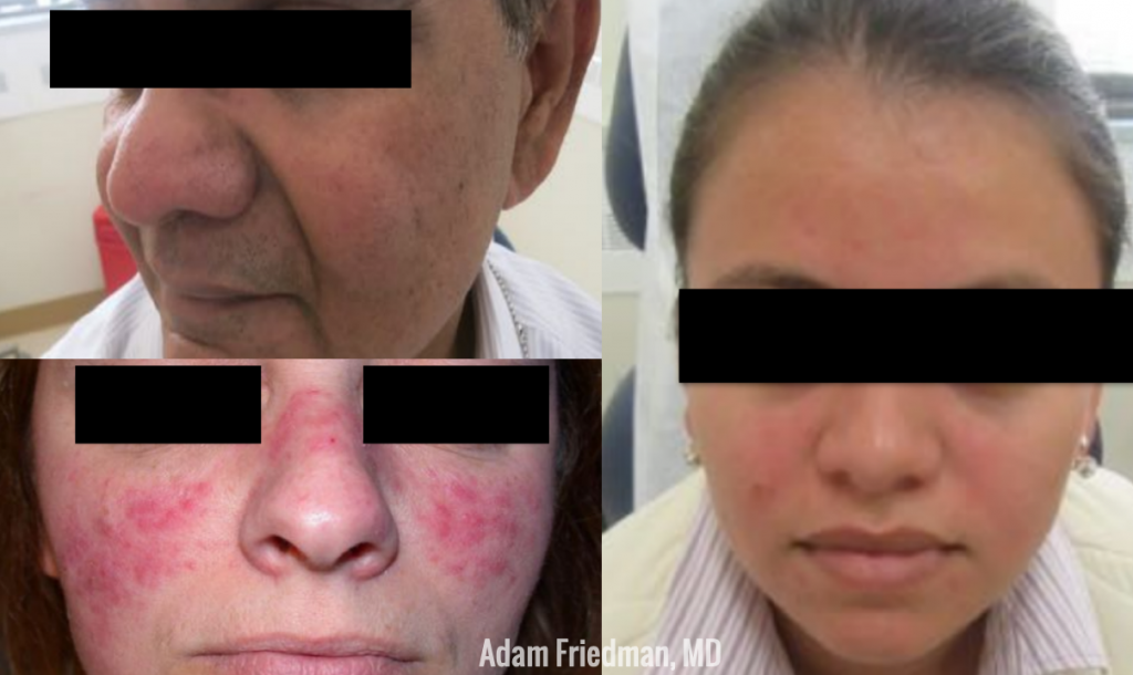 Pathophysiology and Management of Rosacea: Pearls from the Expert ...