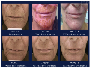 Perioral Combination Therapy - Pearls from the Expert - Next Steps in ...