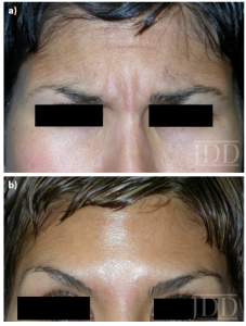 Social Significance of the Eyebrows and Periorbital Complex - Next ...
