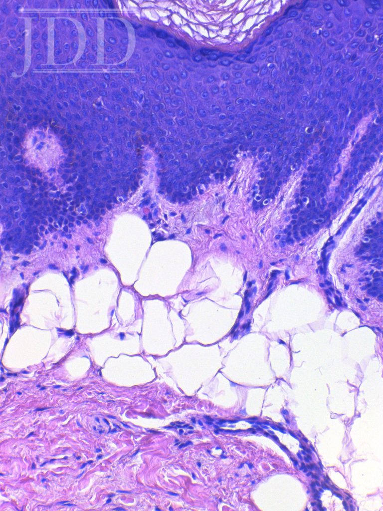 Skin Papules - Friday Pop Quiz - 7/12 - Next Steps in Dermatology