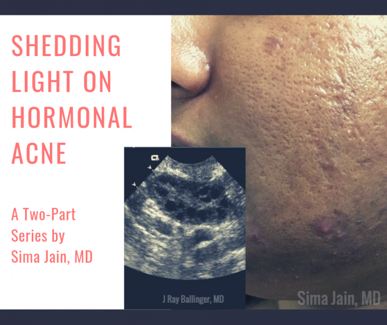 Part 2 – Hormonal Acne: Diagnostic Workup and Treatment Options - Next ...