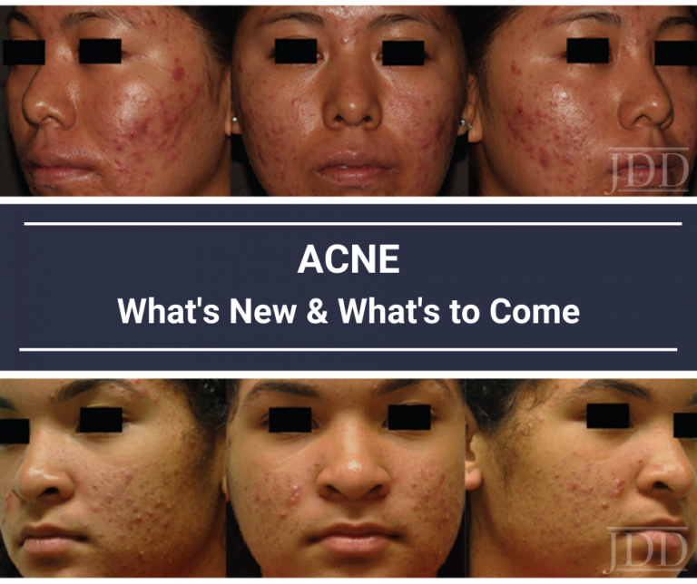 Acne: What’s New and What’s to Come? - Next Steps in Dermatology