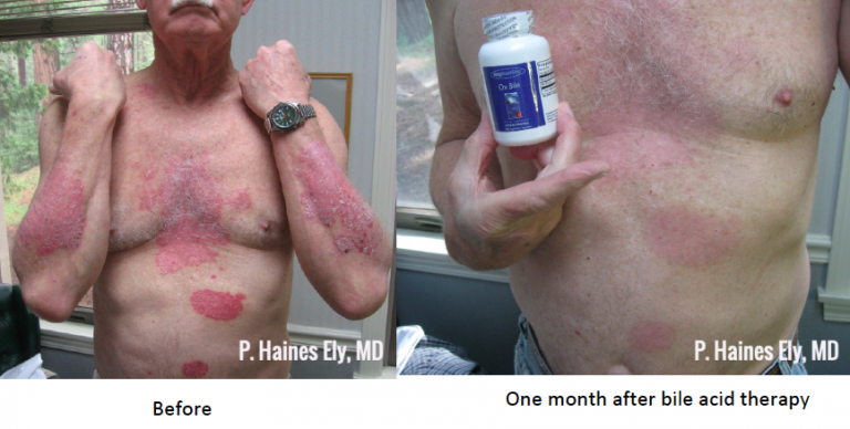 Healing the Gut to Treat Psoriasis? - Next Steps in Dermatology