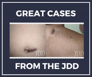 Lichen Myxedematosus Archives - Next Steps in Dermatology