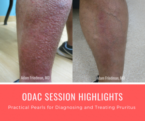 Treating Pruritus: Well...It's Complicated! - Next Steps in Dermatology