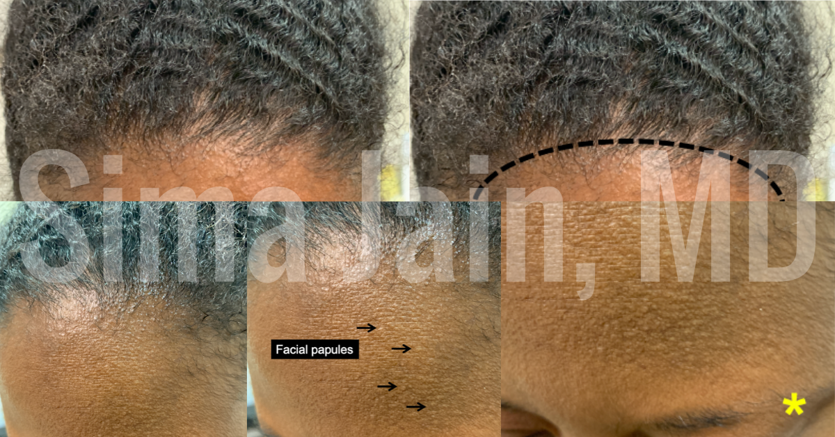 Using Dermoscopy to Diagnose Difficult Clinical Conditions - Next Steps ...