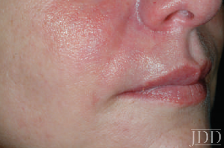 Vascular Complications of Fillers: Treatment Pearls for Impending ...