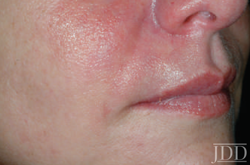 Vascular Complications of Fillers: Treatment Pearls for Impending ...