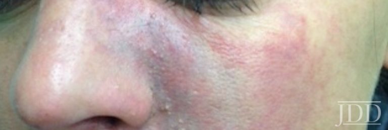 Vascular Complications of Fillers: Treatment Pearls for Impending ...