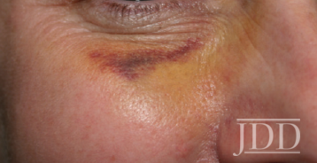 Vascular Complications of Fillers: Treatment Pearls for Impending ...