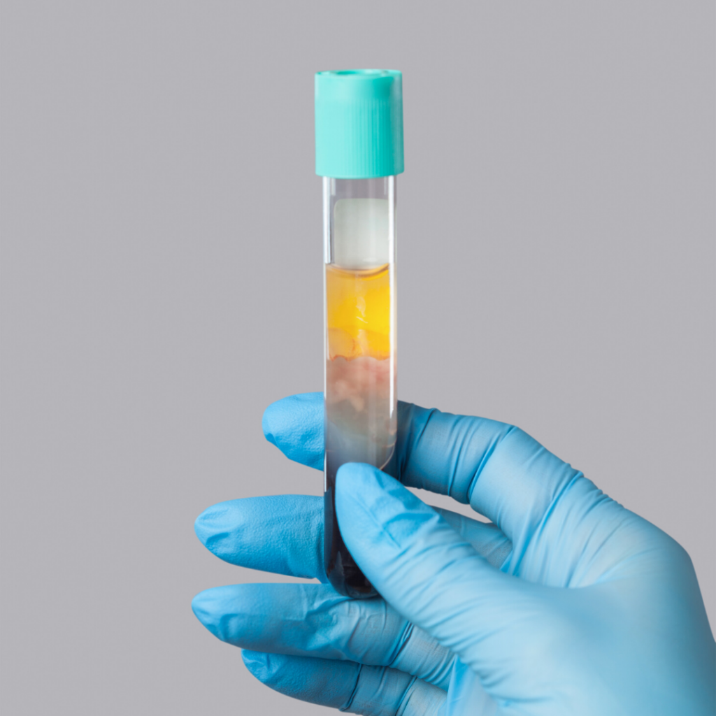 Platelet Rich Plasma: “The Process Is The Product” - Next Steps in ...