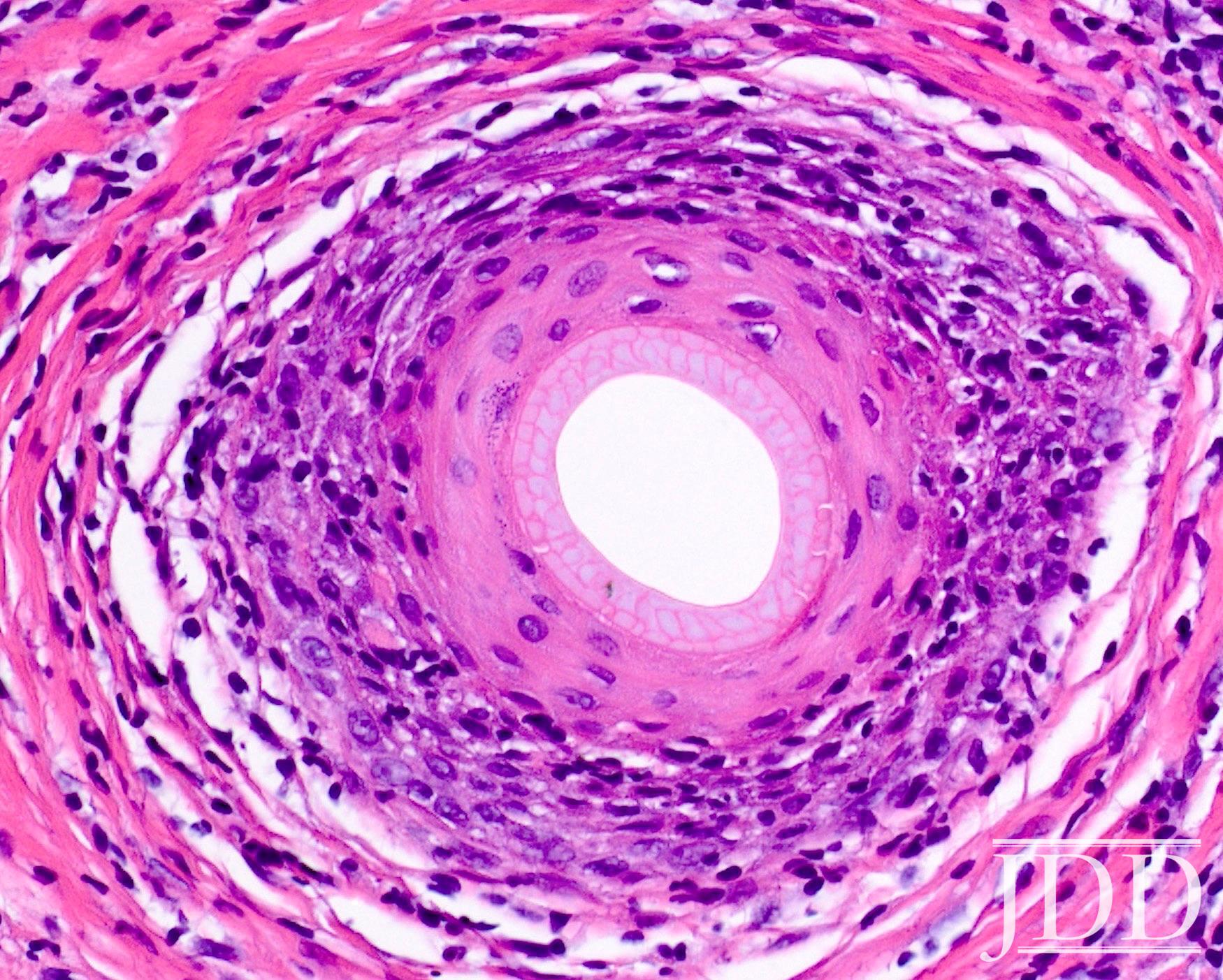 Frontal Fibrosing Alopecia Presenting as Androgenetic Alopecia in an ...