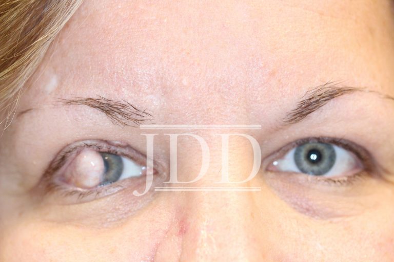 Ocular Dermoid in Patient With Basal Cell Nevus Syndrome - Next Steps ...