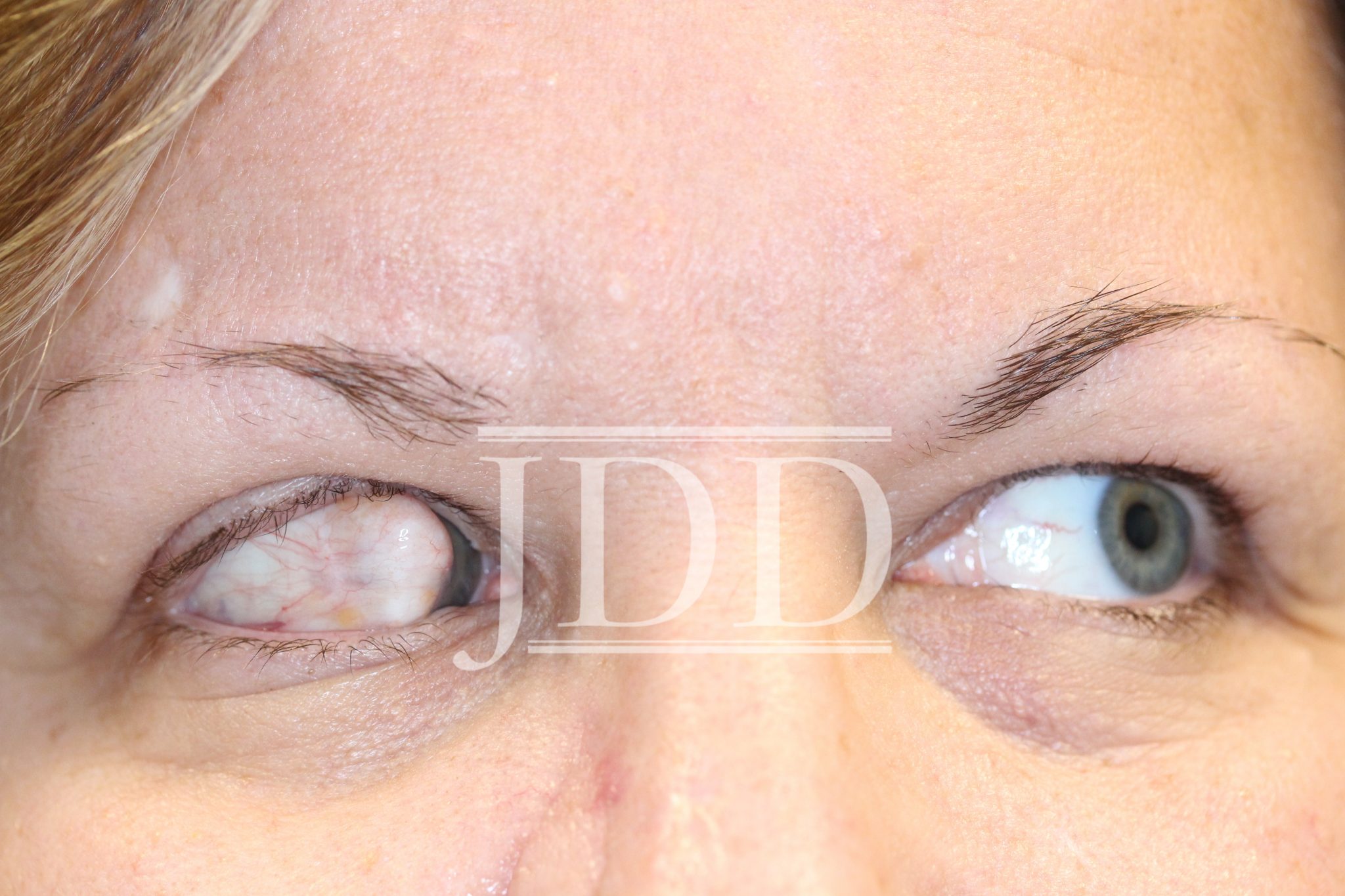 Ocular Dermoid in Patient With Basal Cell Nevus Syndrome - Next Steps ...