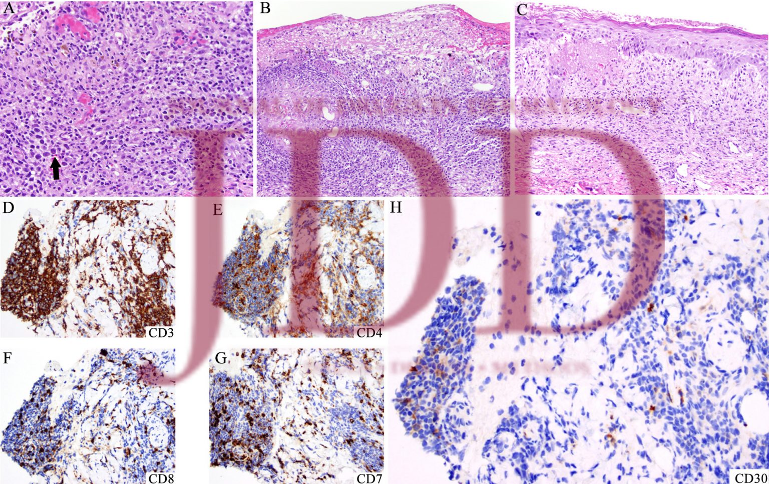 Widespread Skin Necrosis Secondary to Gemcitabine Therapy - Next Steps ...