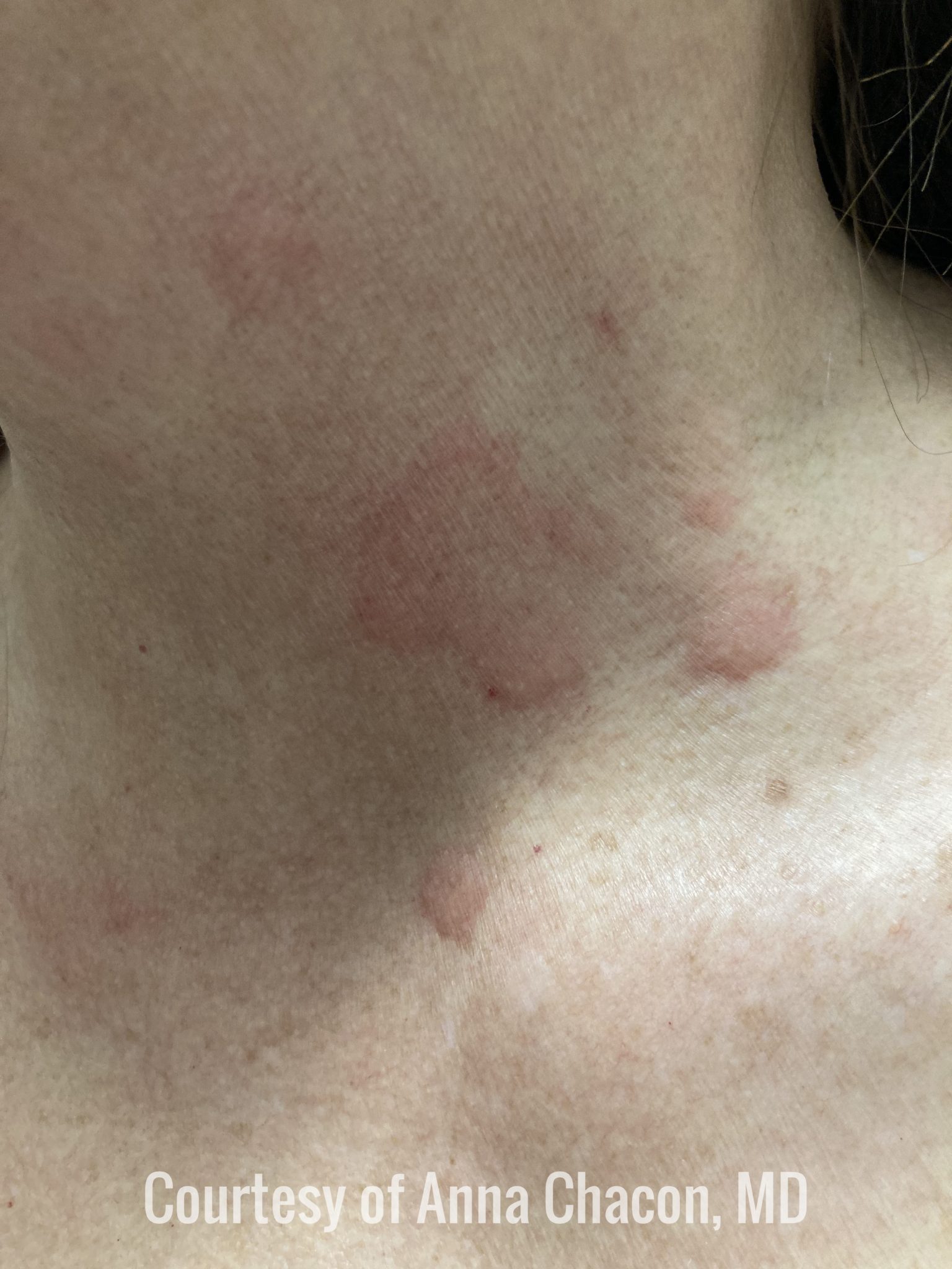 Skin Findings in COVID-19 Patients - Next Steps in Dermatology
