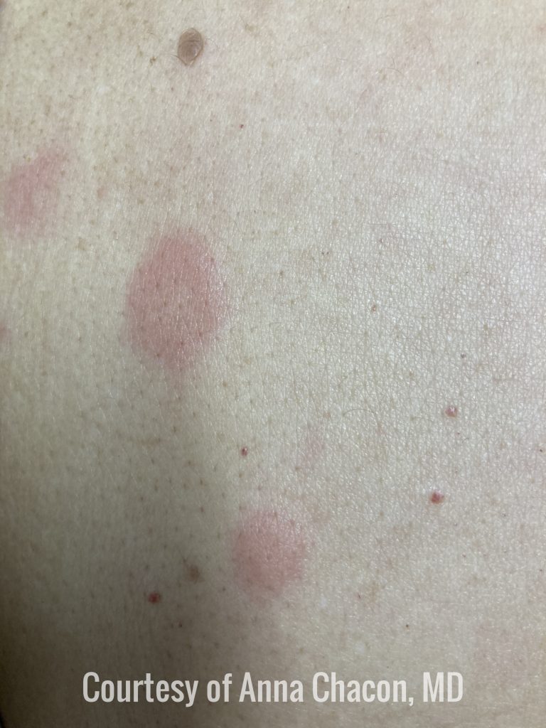 Skin Findings in COVID-19 Patients - Next Steps in Dermatology