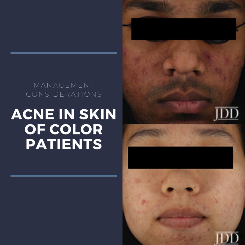 Management Considerations for Skin of Color Patients with Acne - Next ...