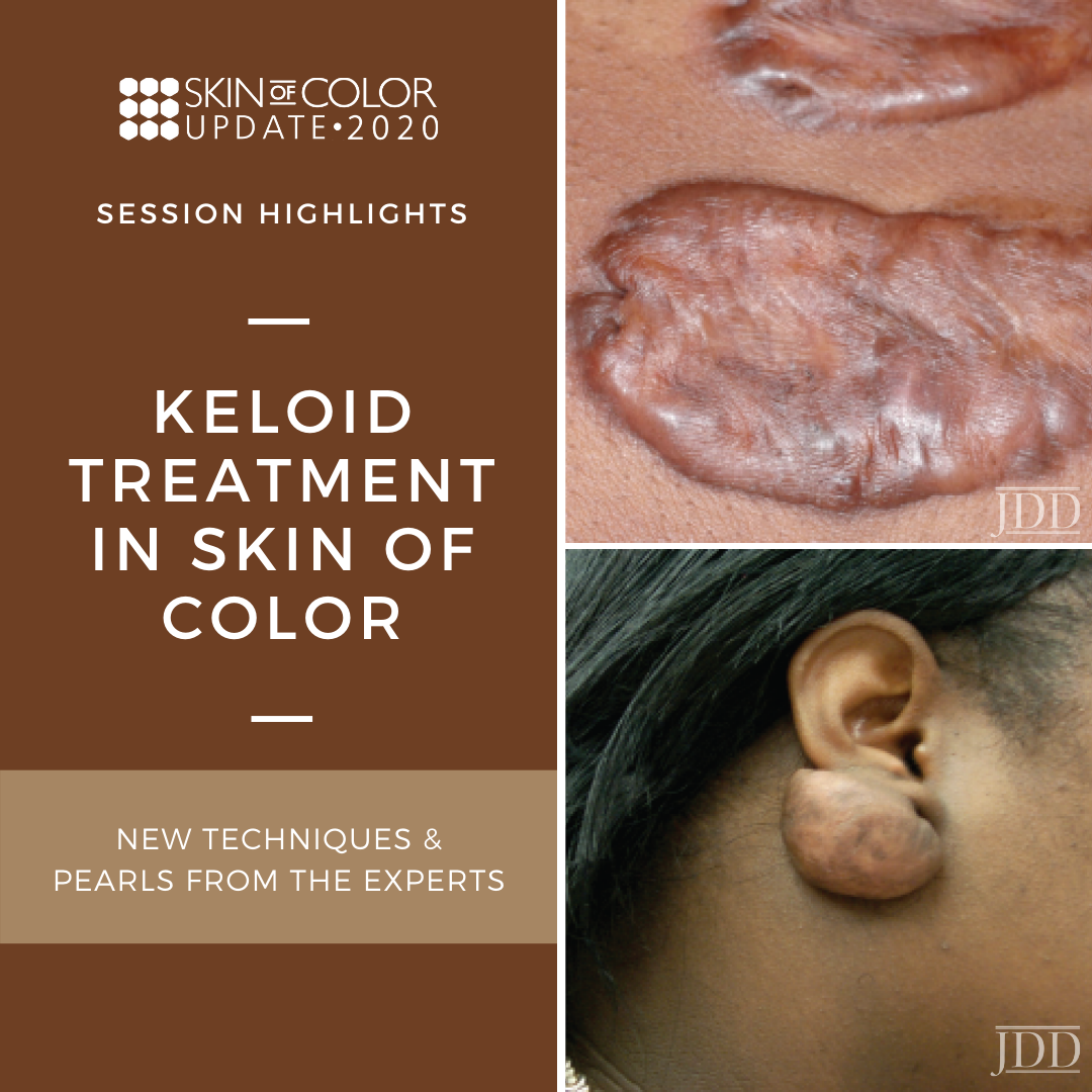 KeloidsSoc_IG-2 - Next Steps in Dermatology