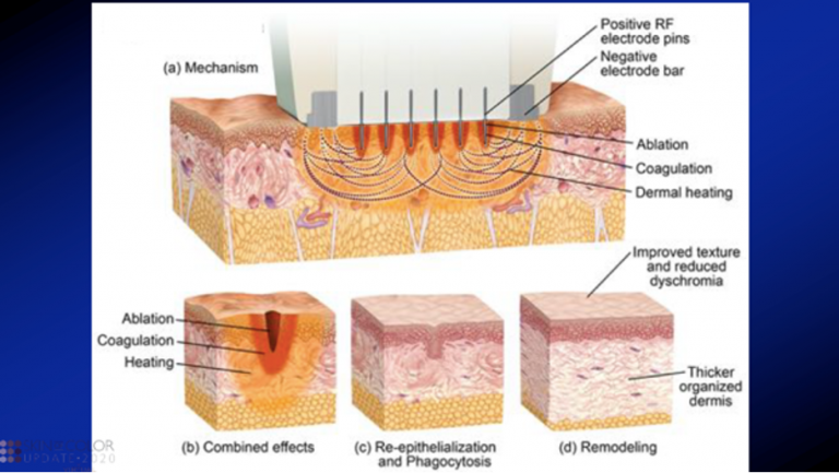 Practical Applications of Lasers and Energy-Based Modalities in Skin of ...