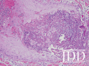It's Mnemonic Monday! Elastosis Perforans Serpiginosa (EPS) - Next ...