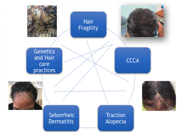 More than Splitting Hairs: Diagnosing Alopecia in Skin of Color - Next ...