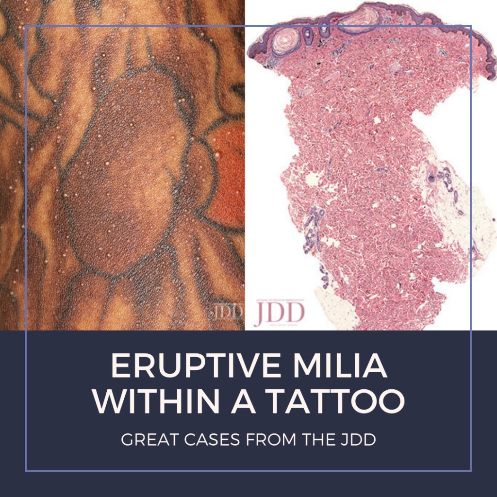 secondary milia Archives - Next Steps in Dermatology