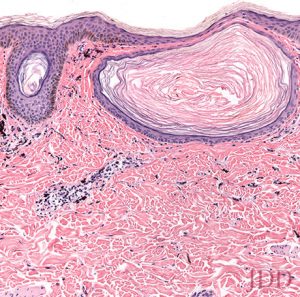 Eruptive Milia Within a Tattoo - Next Steps in Dermatology