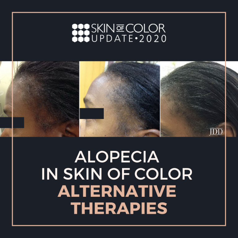Alopecia in Skin of Color: Alternative Therapies - Next Steps in Dermatology