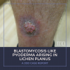 Blastomycosis-like Pyoderma Arising in Lichen Planus - A JDD Case ...