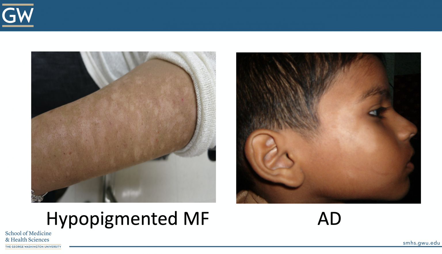 Easing the Management of Atopic Dermatitis - Next Steps in Dermatology