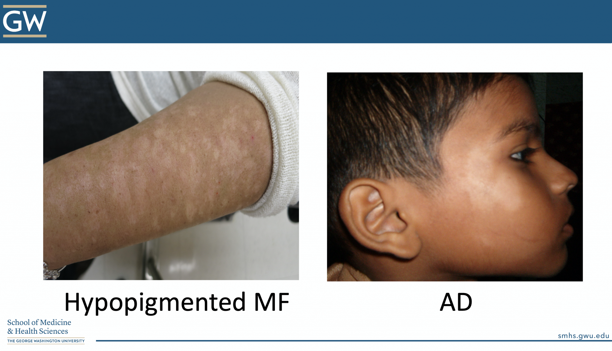 Easing the Management of Atopic Dermatitis - Next Steps in Dermatology
