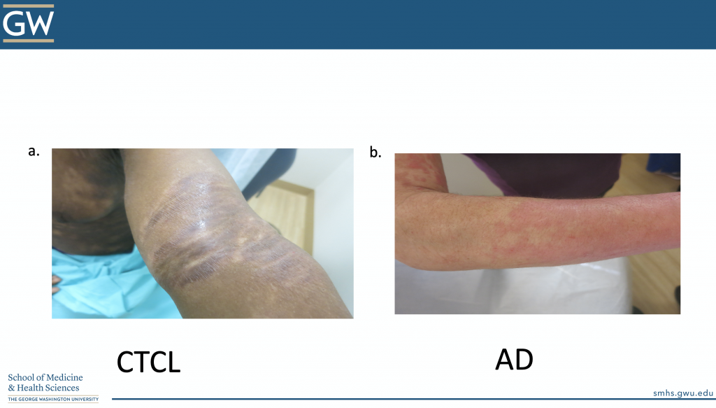Easing the Management of Atopic Dermatitis - Next Steps in Dermatology