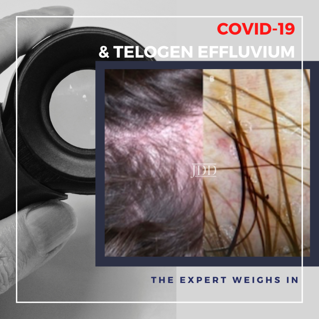 Patient Buzz: COVID-19 & Telogen Effluvium - Next Steps in Dermatology
