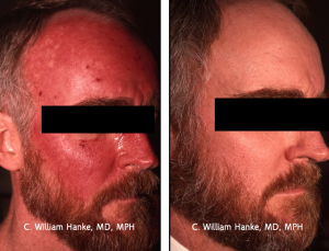 Actinic Keratoses: Evidence-Based Treatment Options - Next Steps in ...