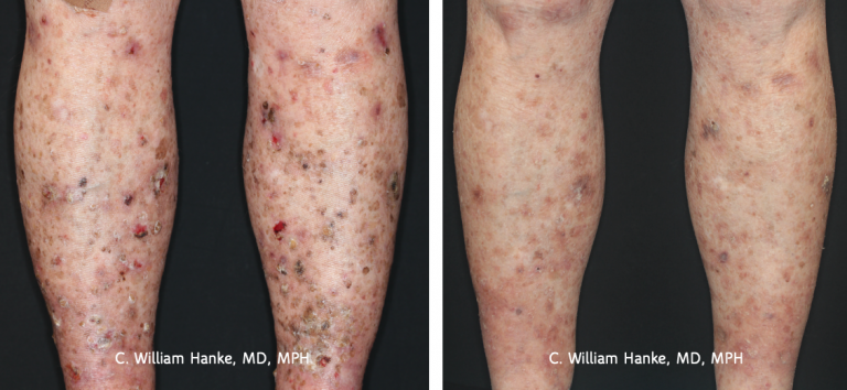 Actinic Keratoses: Evidence-Based Treatment Options - Next Steps in ...