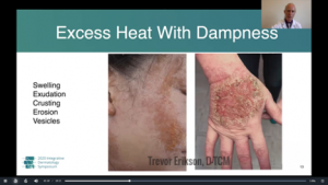 Treatment of Atopic Dermatitis with Chinese Herbal Medicine - Next ...