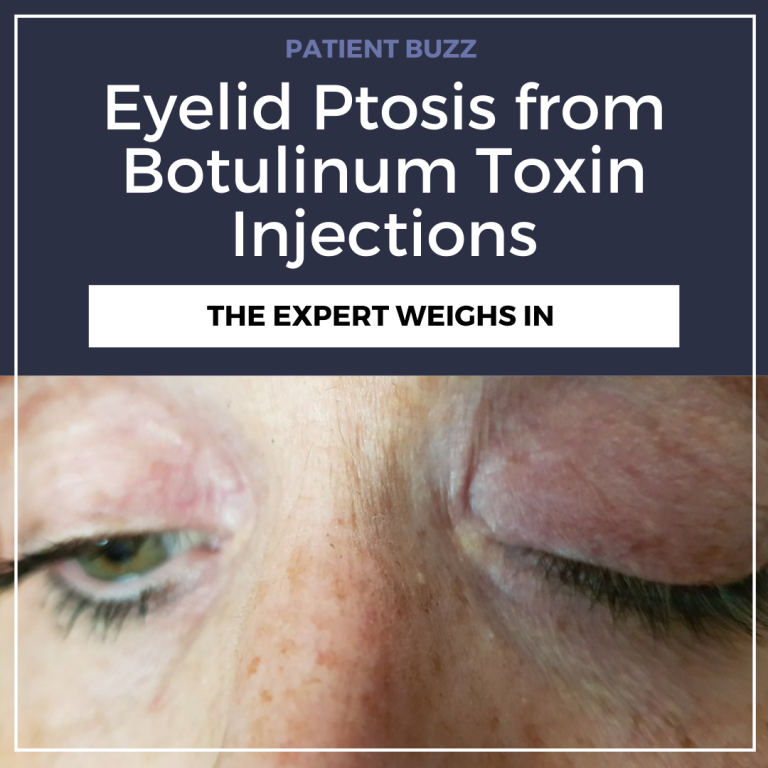 Patient Buzz: Eyelid Ptosis from Botulinum Toxin Injections - Next ...