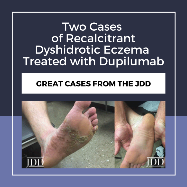 Recalcitrant Dyshidrotic Eczema Treated With Dupilumab - Next Steps in ...
