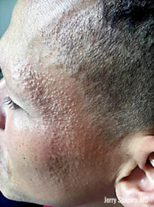 Facial Papules of FFA - Next Steps in Dermatology