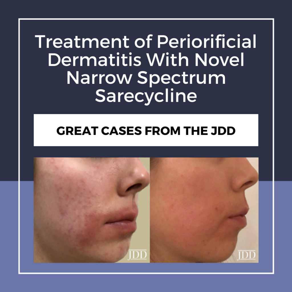 Treatment of Periorificial Dermatitis With Novel Narrow Spectrum ...