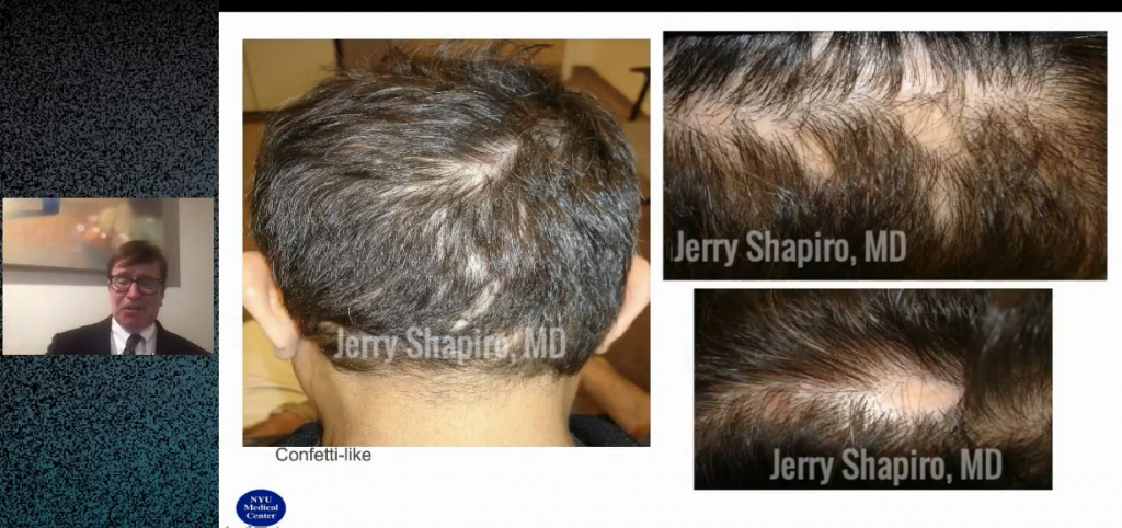 Lichen Planopilaris and Frontal Fibrosing Alopecia: Treatment ...