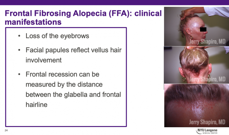 Lichen Planopilaris and Frontal Fibrosing Alopecia: Treatment ...