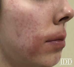 Treatment of Periorificial Dermatitis With Novel Narrow Spectrum ...